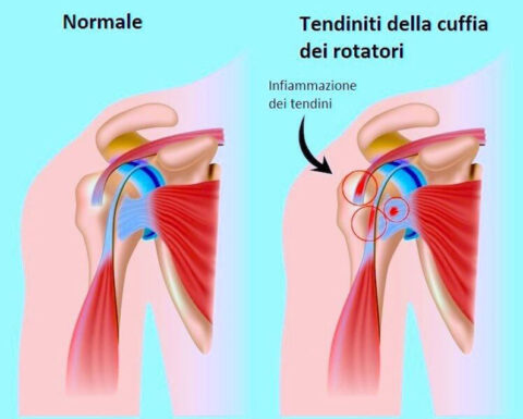 Quale Fisioterapia per la Tendinite - Fisioterapia Latina