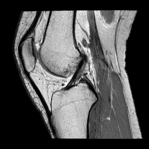 Ricostruzione Legamento Crociato Anteriore Ginocchio - Fisioterapia Latina