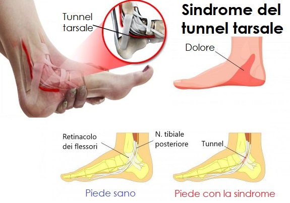 Dolore alla Caviglia dopo la corsa: cause e rimedi - Fisioterapia Latina