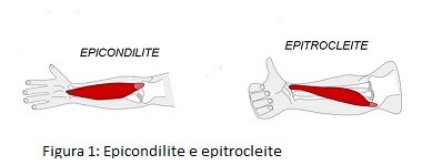 Dolore al Gomito e Fisioterapia. In cosa consiste e quando farla ...