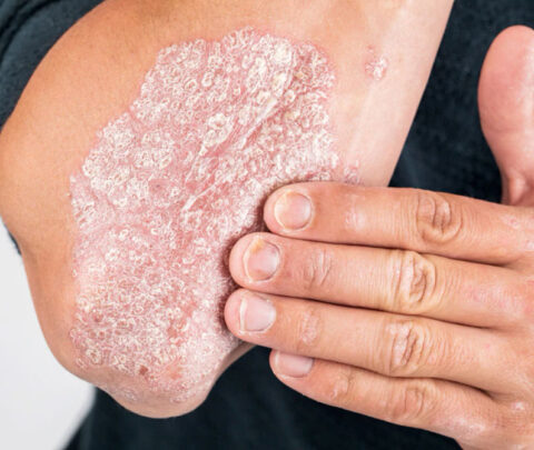 Psoriasi: cos’è, tipologie, cause e cure - Fisioterapia Latina