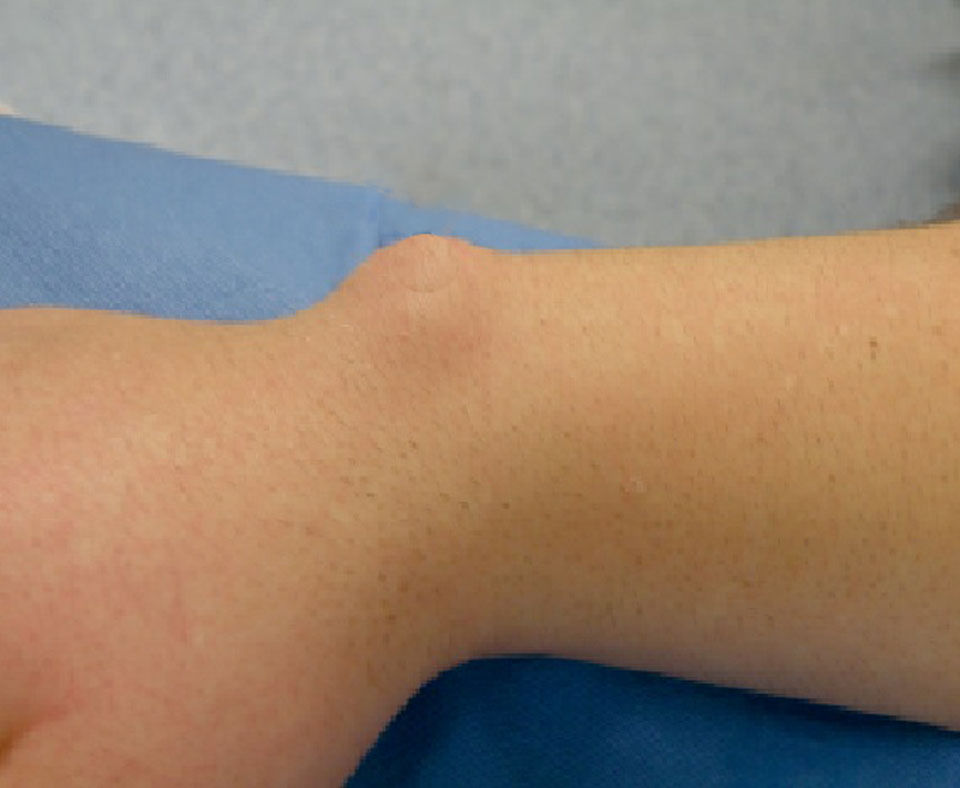 Cisti Gangliare: cos’è e come curarla - Fisioterapia Latina