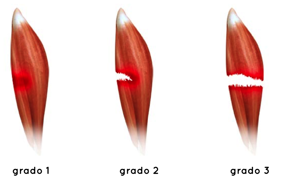 Fisioterapia per lo strappo muscolare (stiramento - lesione ...